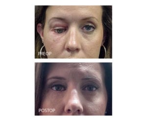 Eye Removal (Enucleation) » Dallas Ophthalmology Surgeons | Texas ...