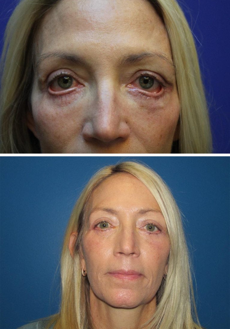 Secondary/Revision Cosmetic Surgery » Dallas Ophthalmology Surgeons ...